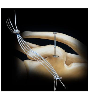 ENDOBOTTON para Acromio Clavicular – STENDO-ACR – VLimplants